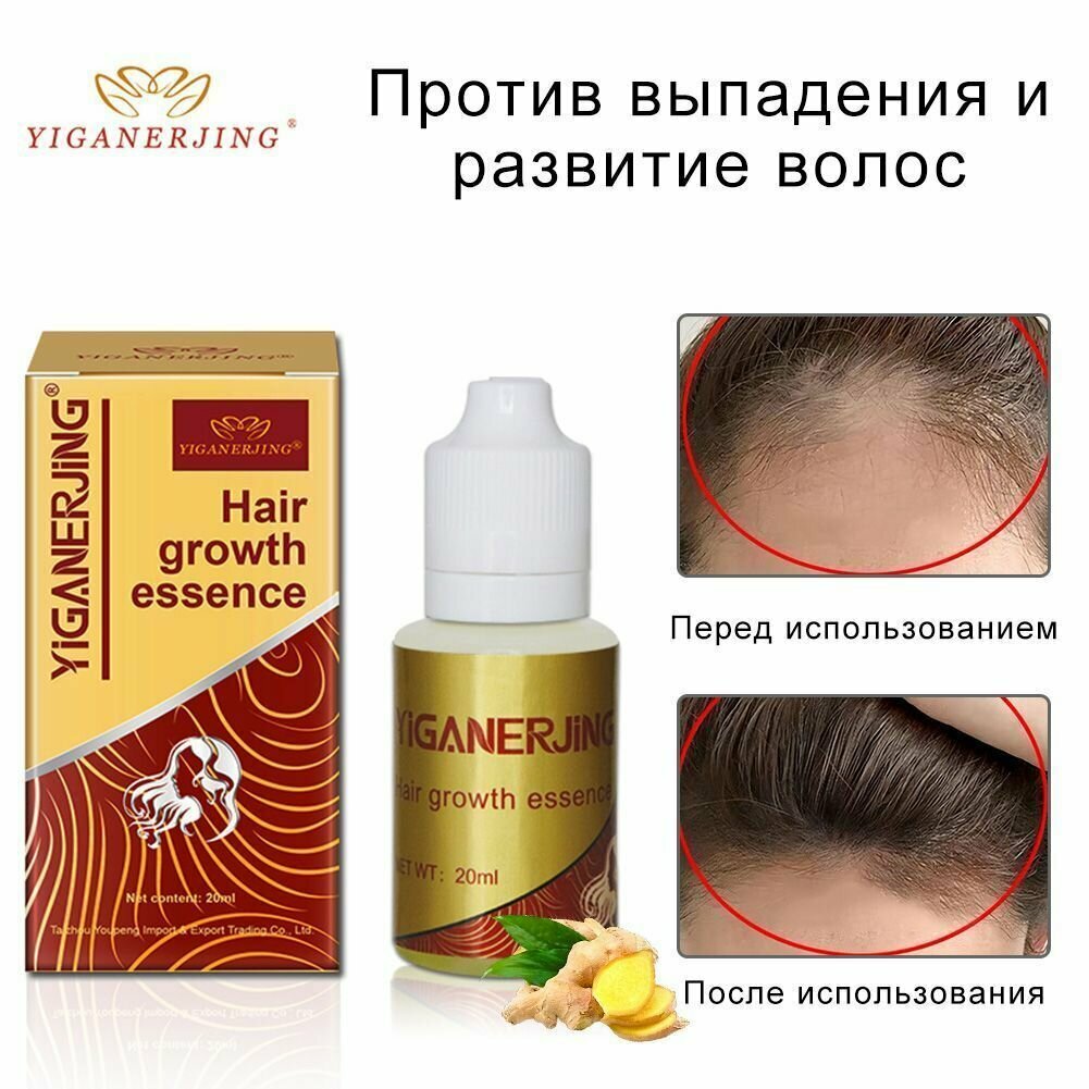 YIGANERJING: Масло против выпадения волос для ускорения роста волос. 1 шт.