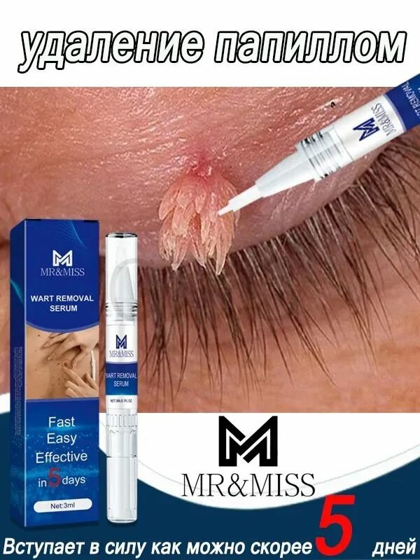 Карандаши для удаления бородавокдля лечения бородавок, средство от папиллом, от бородавок, от мозолей, безболезненный и не вызывающий раздражения / 3 мл