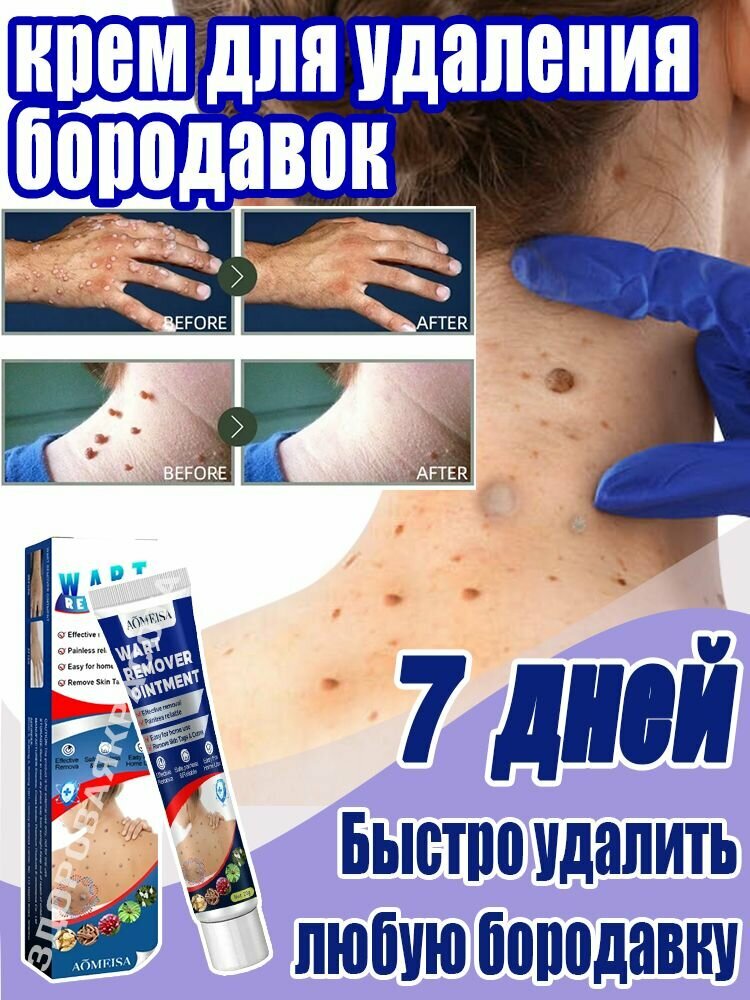 Крем для удаления бородавок для безболезненного удаления бородавок, папиллом и родинок, не оставляя шрамов. Устраняет бородавки за 7 дней без побочных эффектов.