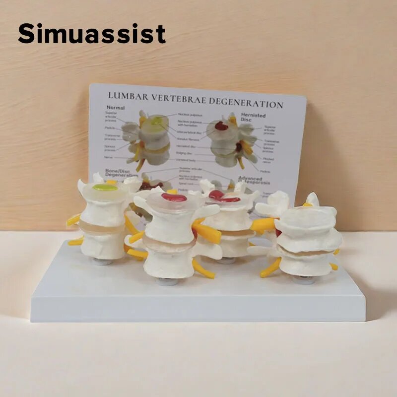4-ступенчатая патологическая модель анатомии поясничного отдела позвоночника человека, учебные ресурсы для медицинских наук