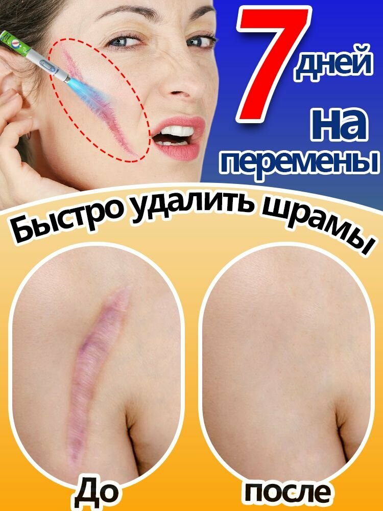 Лазерная ручка для удаления рубцов эффективно удаляет шрамы и следы от ожогов, постакне и растяжки, а также предотвращает их образование. Её можно использовать на любом участке тела. 1 шт.