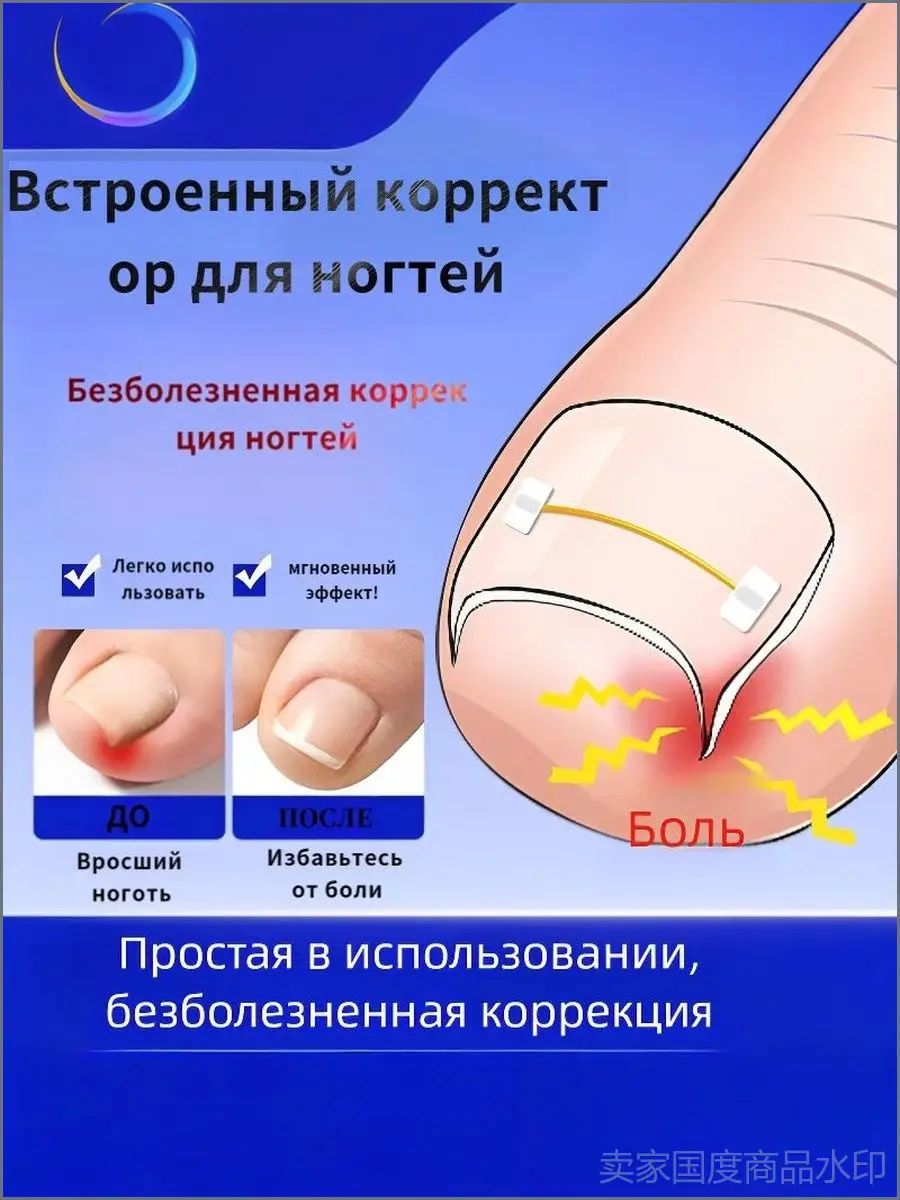 Комплект из 10 никелид-титановых корректоров для вросших ногтей