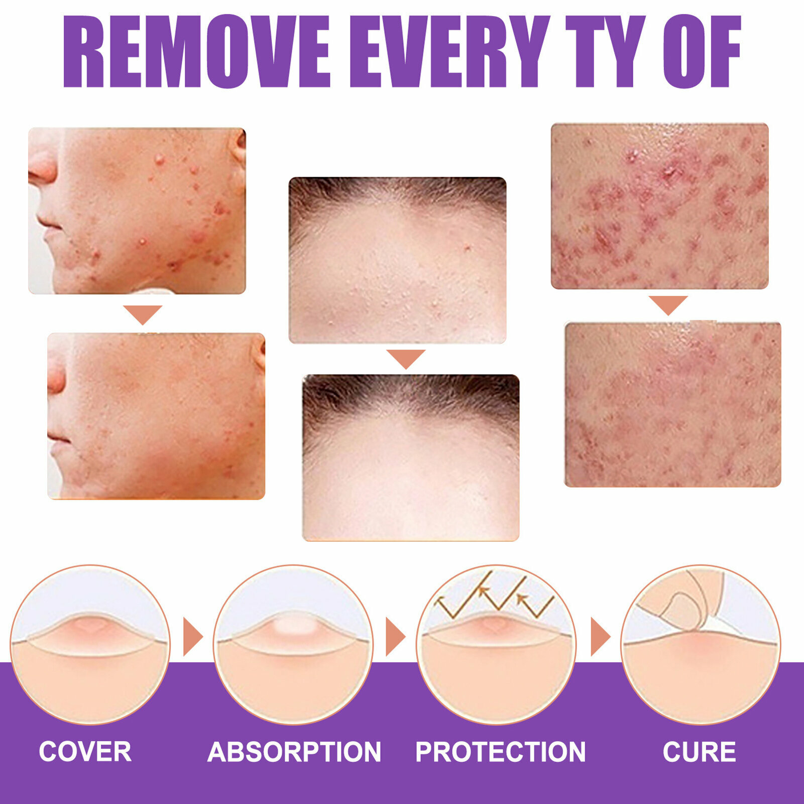 Средство для удаления бородавок EELHOE 30 мл, жидкость для удаления бородавок, жалящих бородавок, наростов на коже шеи и лица, подмышечных остроконечных отростков