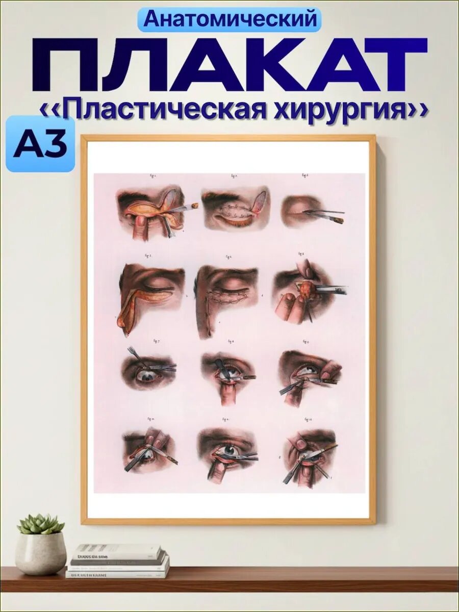 Постер медицинский, перфорант, пластическая хирургия, пластика, А3 анатомия, хирургия