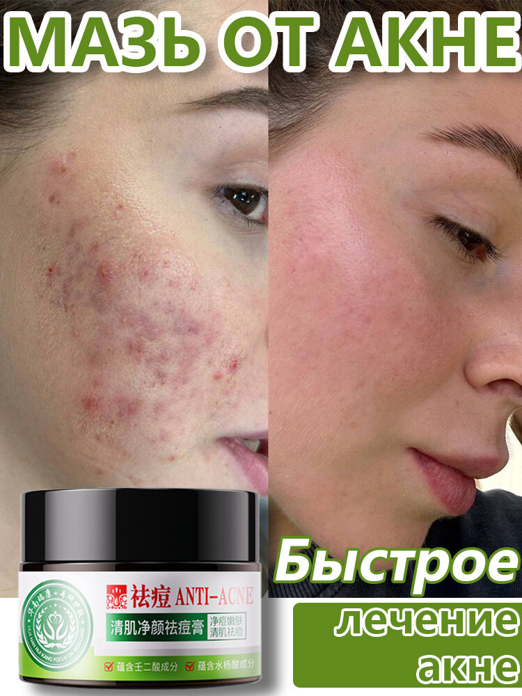 Крем от угрей, 30 г, содержащий салициловую кислоту и азелаиновую кислоту для устранения черных точек и пятен.