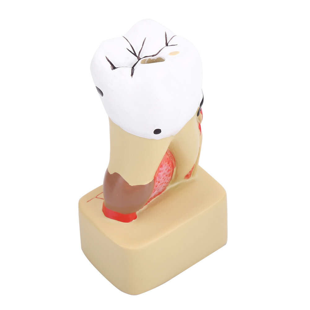 1 шт Модель зуба для обучения и исследования патологических состояний зубов, включая кариес, периодонтит, кровотечение десен, зубной камень, материал: резина, размер: 10 x 5 x 3 см, цвет: как на изображении, предназначена для стоматологов и обучения