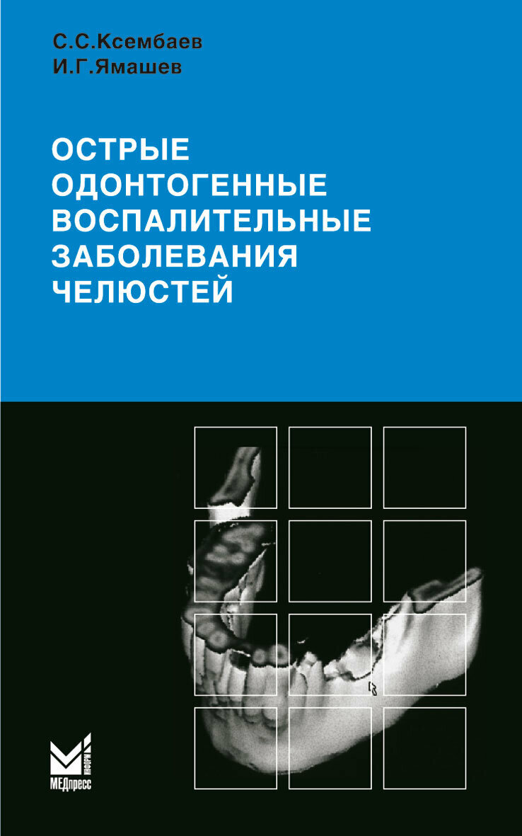 Острые одонтогенные воспалительные заболевания челюстей