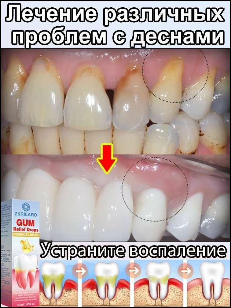 Масло для ухода за полостью рта при рецессии десен, повышенной чувствительности зубов, стоматите и для ухода за деснами. Укрепляет зубную эмаль.1PC