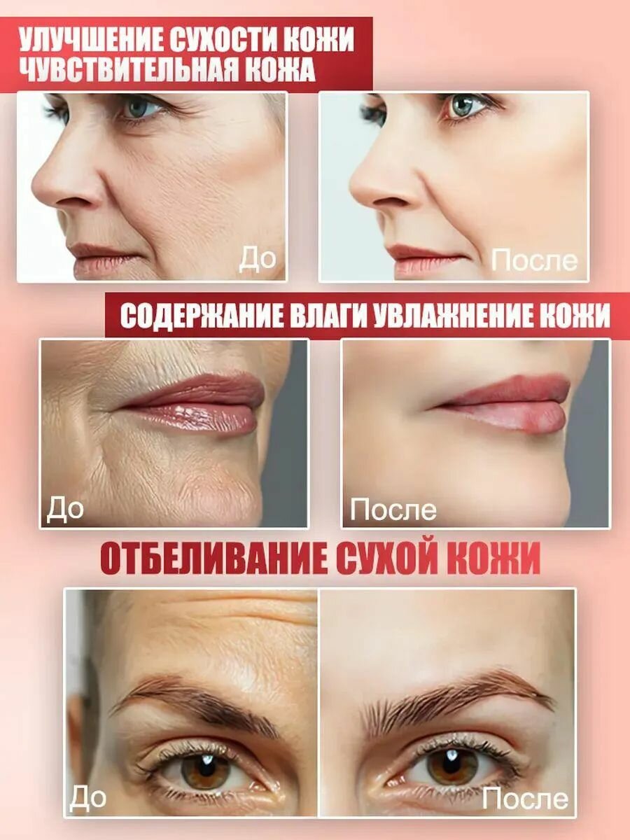 Винная мазь для носа отрозацея и купероза, крем для личения розацеа кожи лица, мазь сосуды носа, Гельтек Гель Демотен Форте от прыщ, крем регенерирующий, 20г