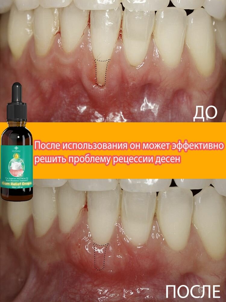 Используется для лечения пародонтита, стоматита, снятия чувствительности и отека десен, восстановления, профилактики и укрепления поврежденных десен, 30 мл, 3 флакон