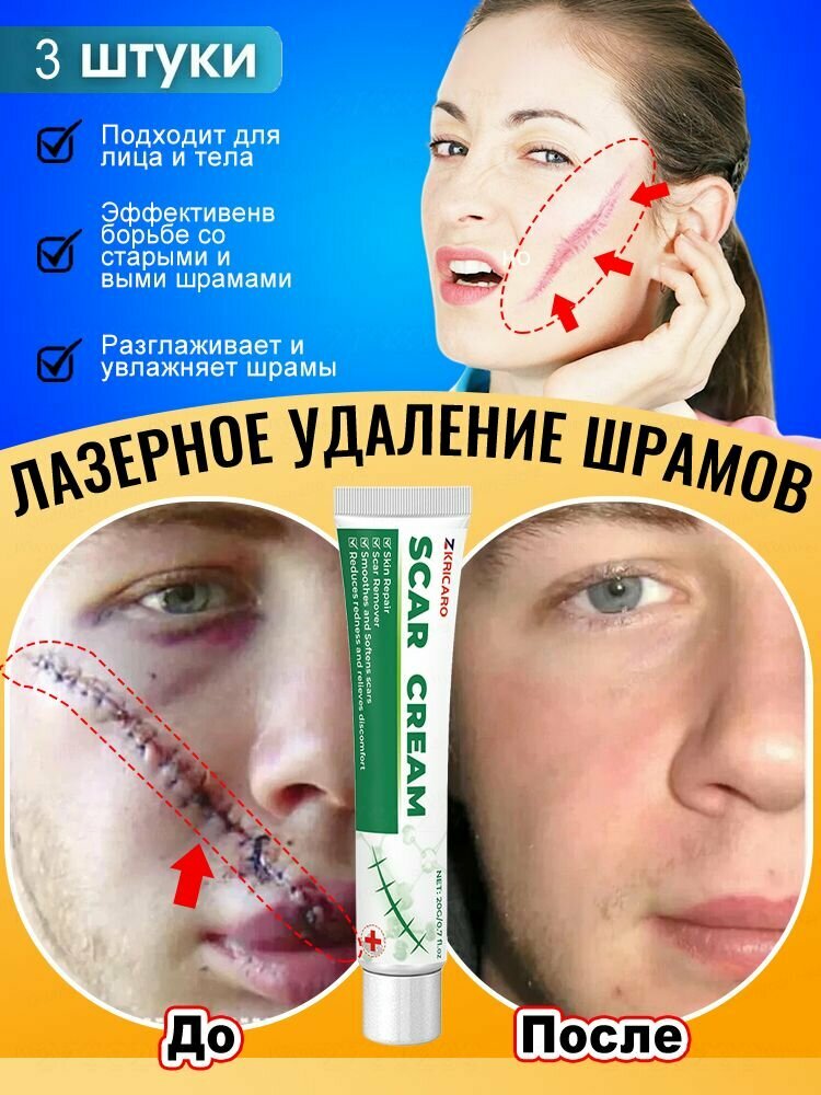 Крем от шрамов и рубцов, гель от прыщей на лице, мазь против ожогов и пигментных пятен и теле, средство от постакне30 г