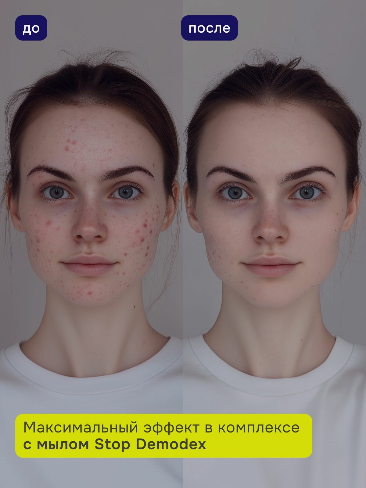 Лосьон для лица и век при демодекозе и акне Стоп демодекс Stop demodex 150мл