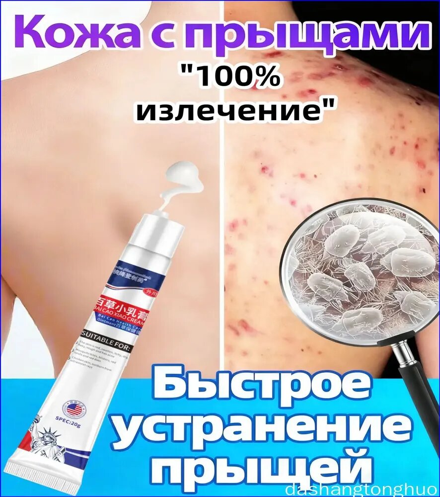 Крем от угревой сыпи, 20 г, может эффективно удалять кожных клещей и угри, глубоко очищая кожу.