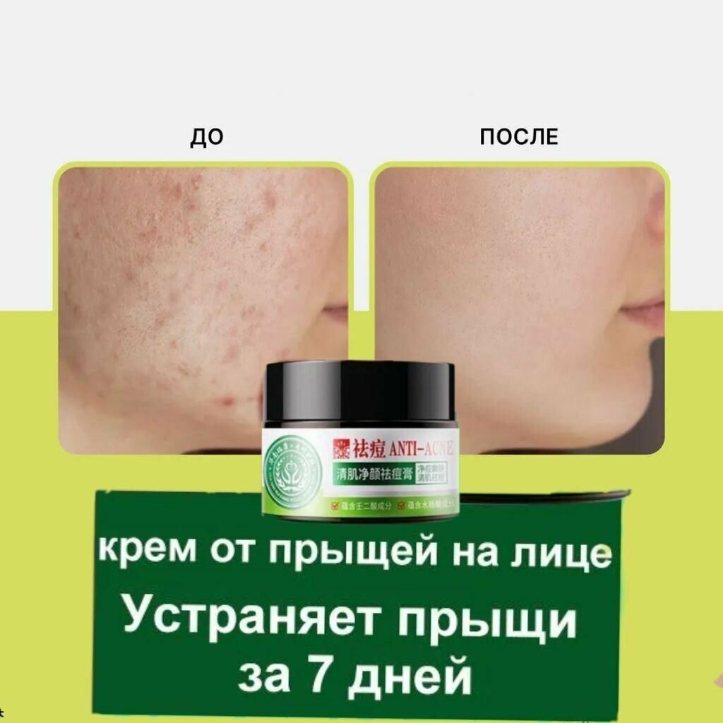 Крем для лица от акне прыщей воспалений, постакне быстрое заживление , для наружного применения, для подростков и взрослых 30 г