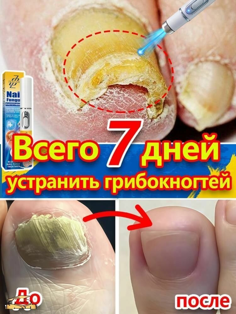 Лазерная ручка для ногтей и кожи от грибка, лечение грибка ногтей