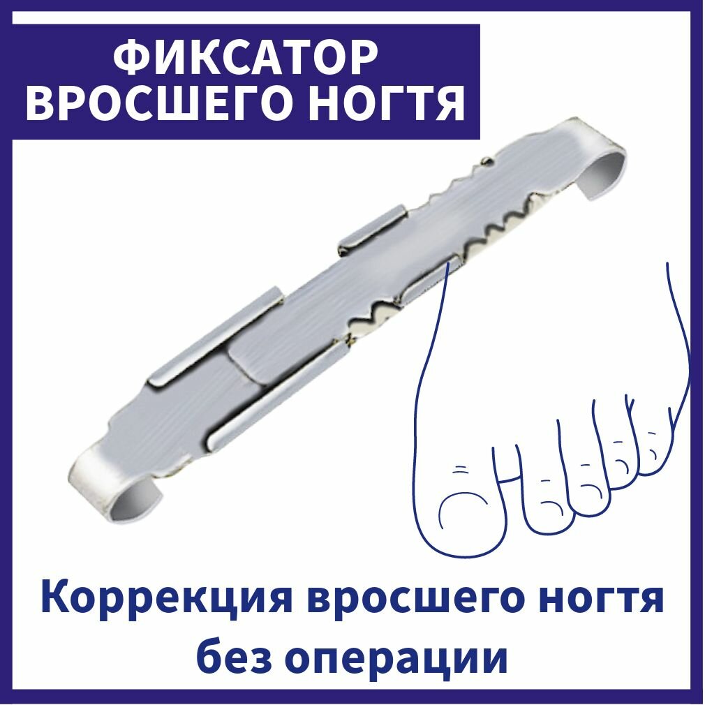 Корректор фиксатор вросшего ногтя