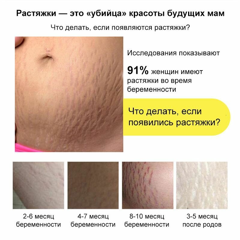 Средство от растяжек — фото 1