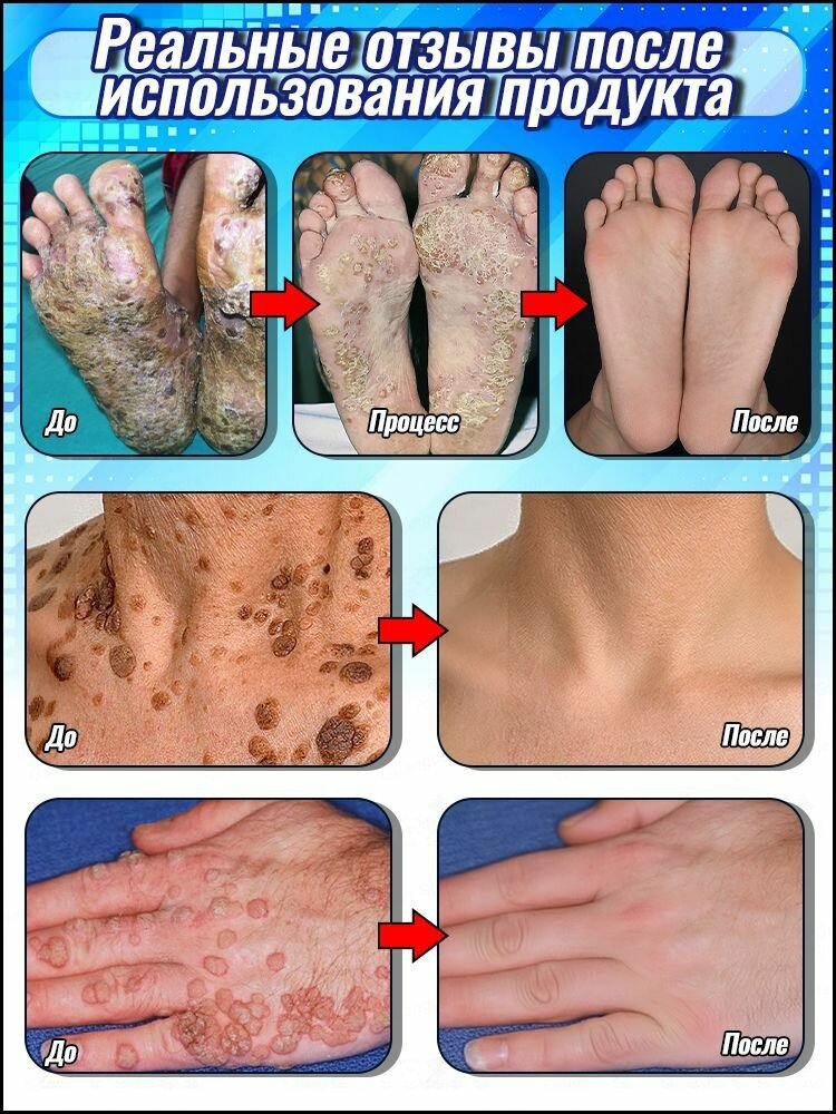 Лазерная указка для удаления бородавок. Удаляйте бородавки, родинки, папилломы и остроконечные кондиломы с тела и лица. Это безопасно, безболезненно и не имеет побочных эффектов.