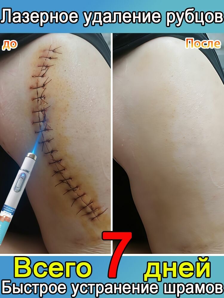 Лазерный аппарат для удаления рубцов. Быстро удаляет гипертрофические , послеоперационные рубцы и после родов, осветляет пигментацию рубцов и делает кожу гладкой. Один кусочек