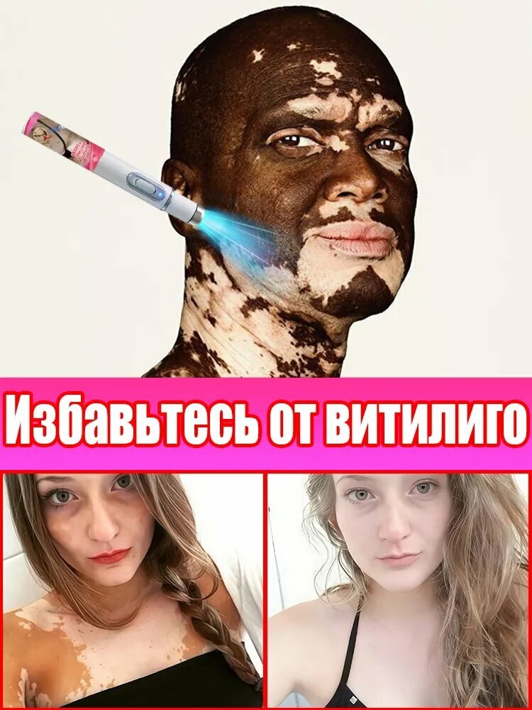 Лазерная указка для устранения витилиго. Эффективно удаляет белые пятна, быстро лечит витилиго, безболезненно и без побочных эффектов