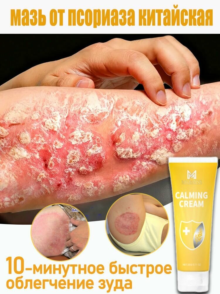 MR&MISS Мазь от псориаза , экземы дерматита лишая прыщей акне постакне негормональное средство. Крем антибактериальный для кожи , заживляющая китайская чудо мазь, для лица, рук и тела ,20г