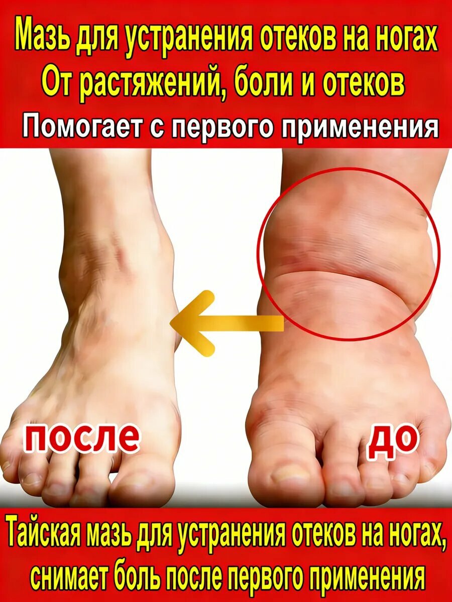 Отек от суставной боли，Мазь от отеков ног