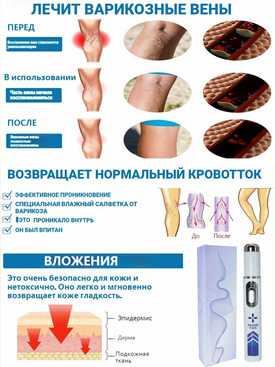 Лазерное лечение варикозного расширения вен. эффективное и быстрое удаление, безболезненное, без шрамов, без побочных эффектов