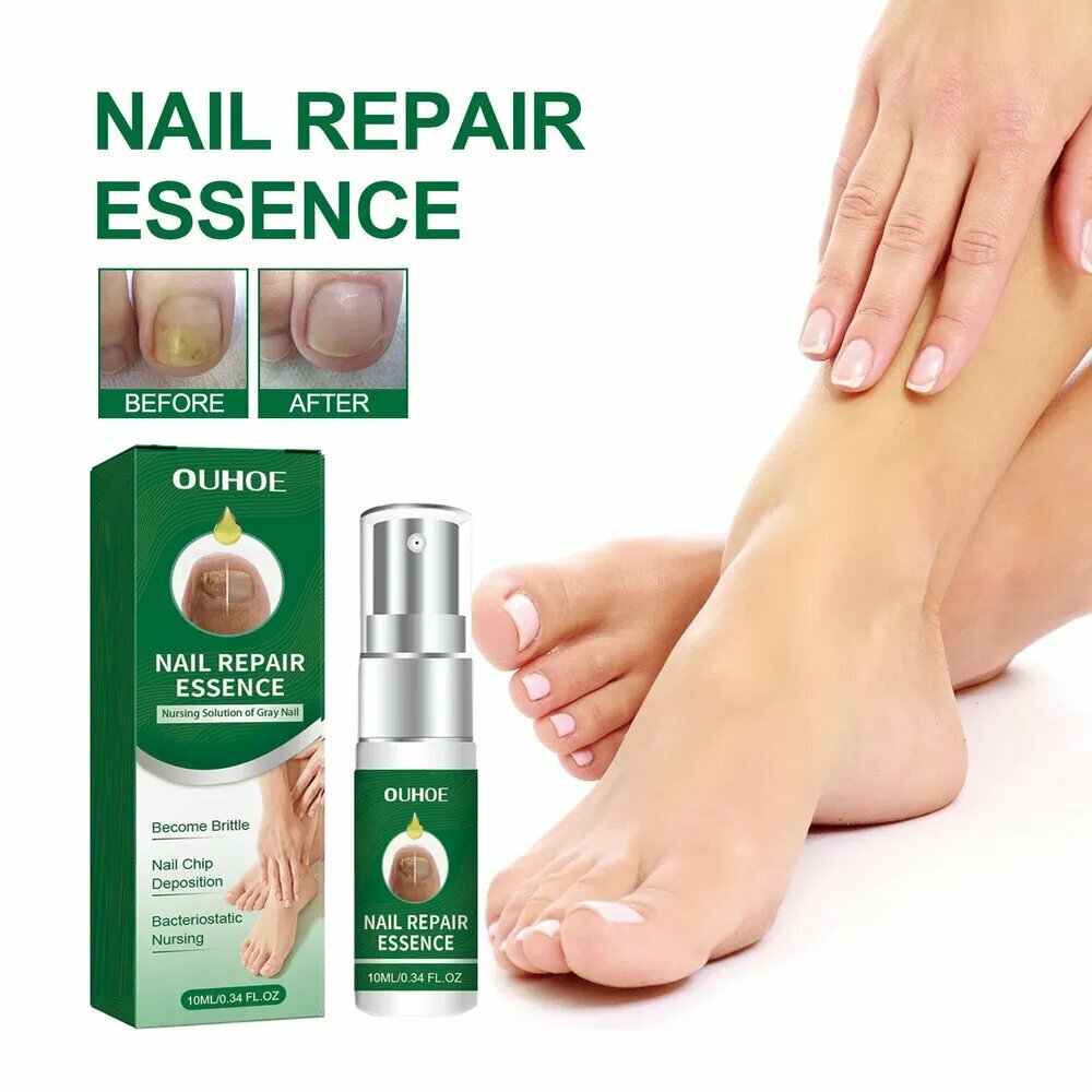 OUHOE 4pcs Эссенция для восстановления ногтей, эндогенный блеск для вросших ногтей