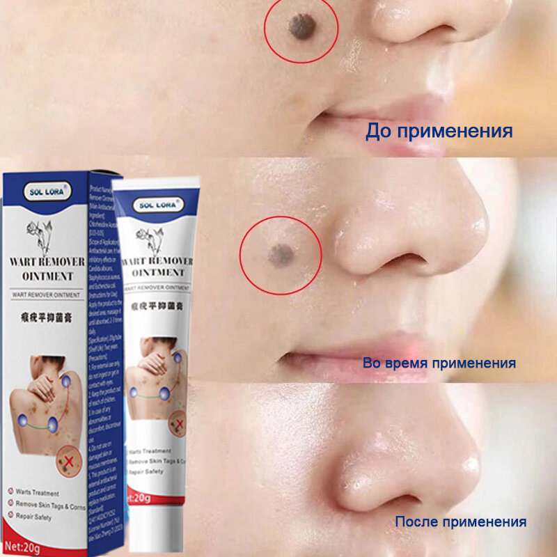 Крем для удаления бородавок и родинок от папиллом и бородавок на проблемной коже лицаСредство для удаления бородавок, папиллом и родинок средство безопасно борется со всеми видами натоптышей
