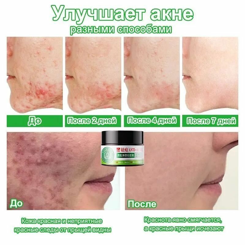Крем для лица от акне прыщей воспалений, постакне быстрое заживление , для наружного применения, для подростков и взрослых 30 г