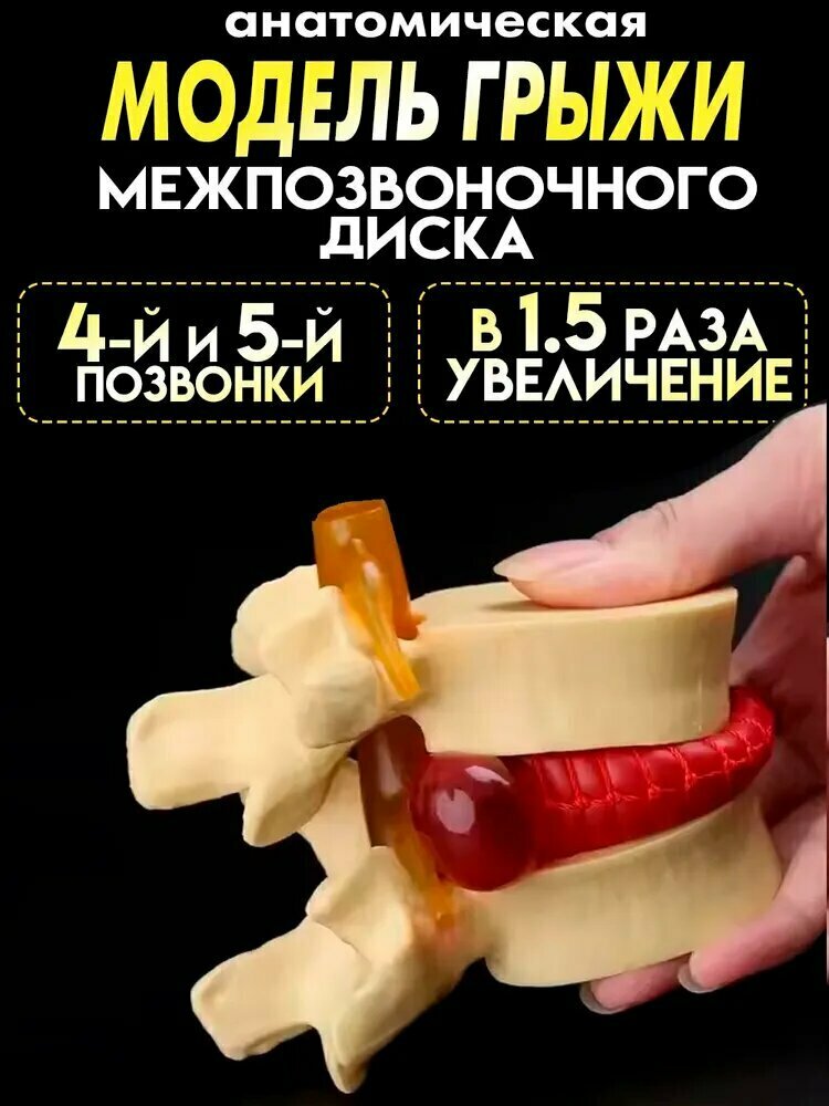 Модель грыжи поясничного диска человека увеличенная в 1,5 раза. Протрузия поясничного отдела позвоночника.