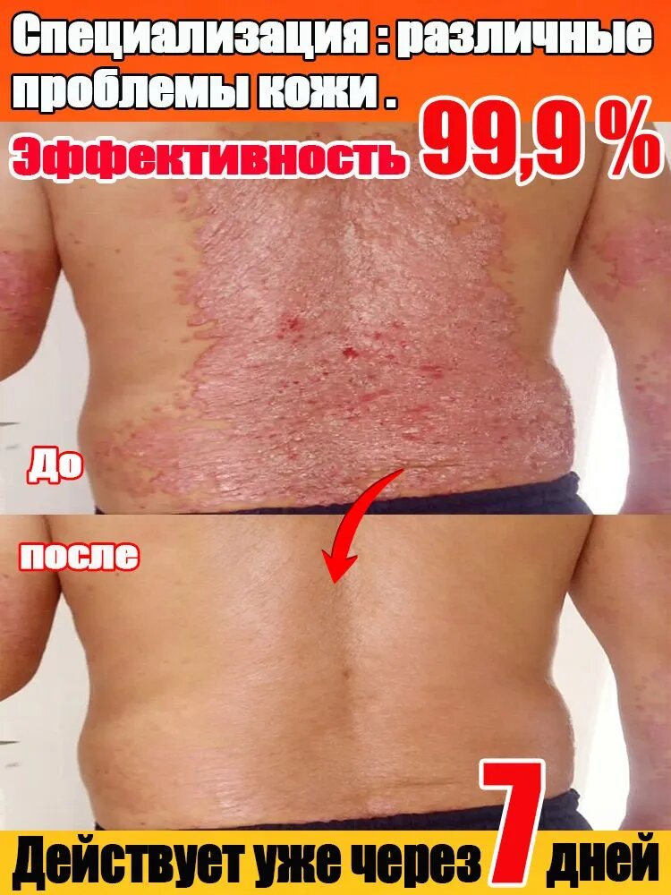Чудодейственный китайский спрей для ухода за кожей. Подходит для лечения псориаза, дерматита и экземы; формула без гормонов; быстродействующий.
