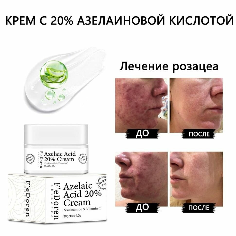 Эксклюзивная антивозрастная эмульсия с 20 азелаиновой кислотой ниацинамидом и биоактивным комплексом