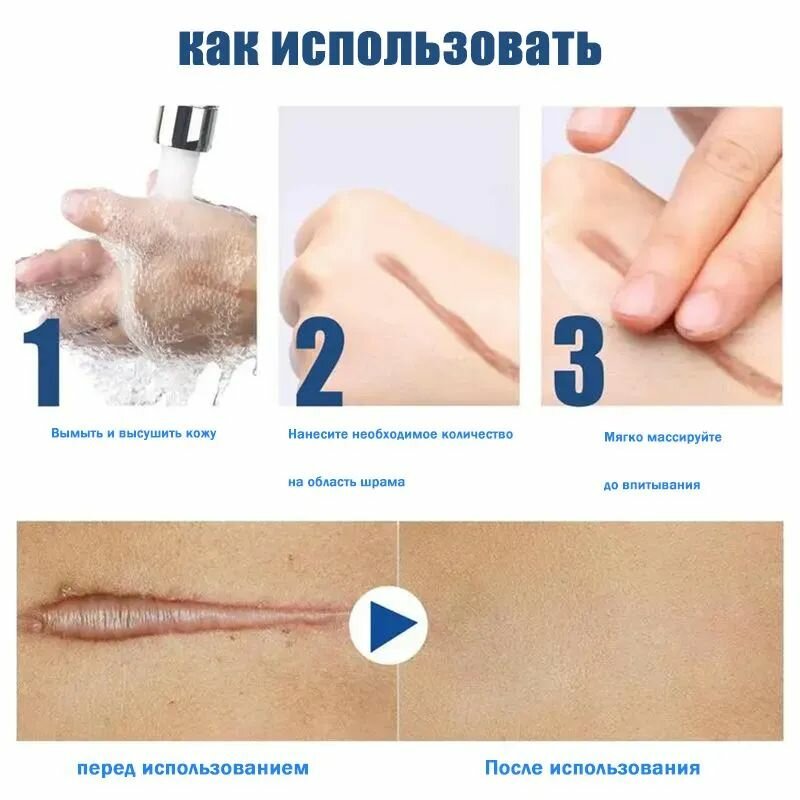 Крем-гель от шрамов, рубцов, растяжек, травм и пигментации, от постакне, от шрамов, рубцов, от пигментации для тела