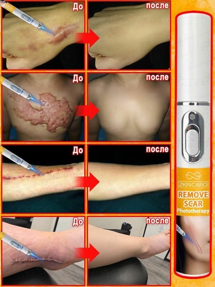 Лазерная ручка для удаления рубцов. Легко удаляет шрамы, гипертрофические рубцы, растяжки, следы от акне и пигментацию, восстанавливая гладкость и безупречность кожи. Подходит для лица и тела.1 шт.