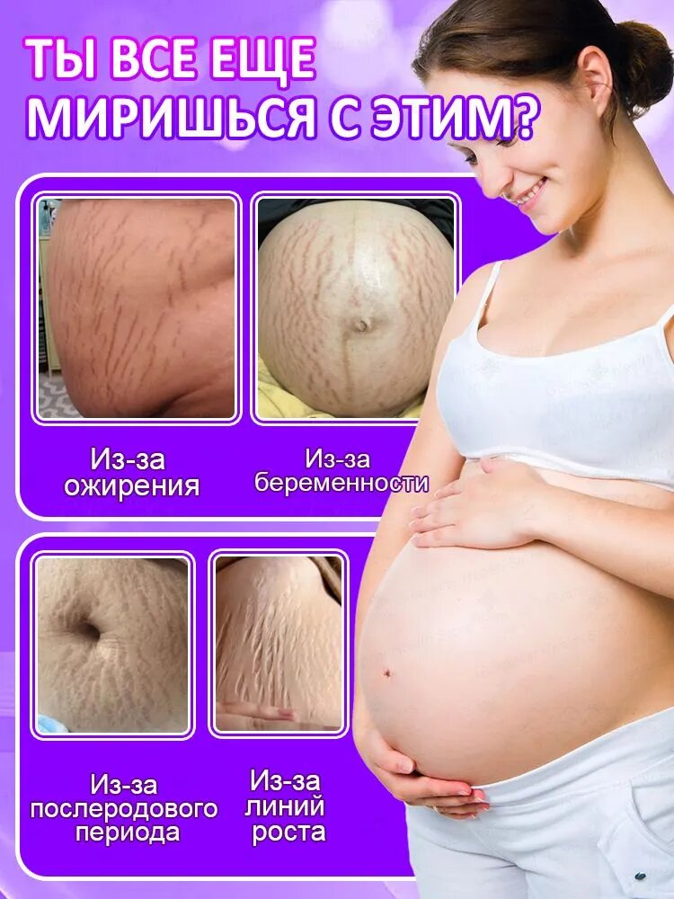 Средство от растяжек, удаляет растяжки, против постакне, шрамов, рубцов и пигментации, подходит для ног и живота, питает кожу, Используйте для восстановления эластичности кожи,90мл