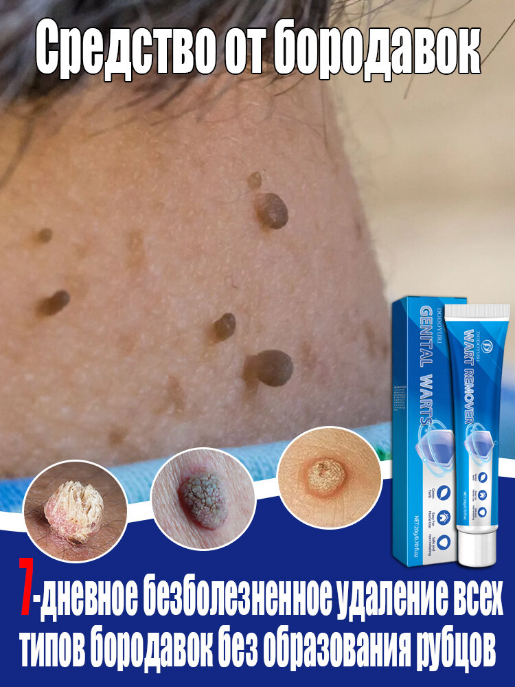 От папиллом средства, лечит папилломы, вызванные белокочанной луковицей, удаляет бородавки и мозоли, способствует здоровому восстановлению кожи, нежный, не оставляет следов, 20 г