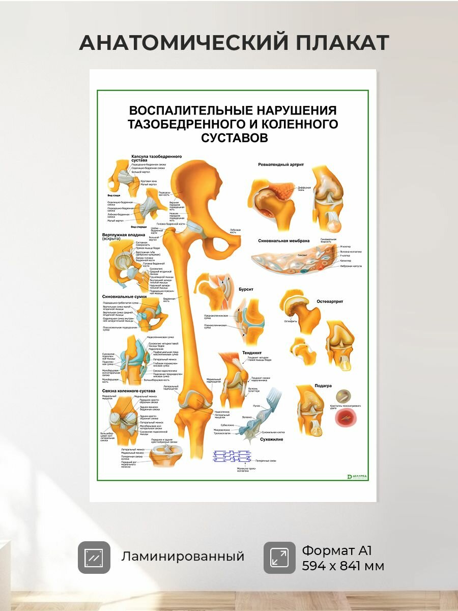 Обучающий медицинский плакат ламинированный формат А1 Воспалительные нарушения тазобедренного и коленного суставов