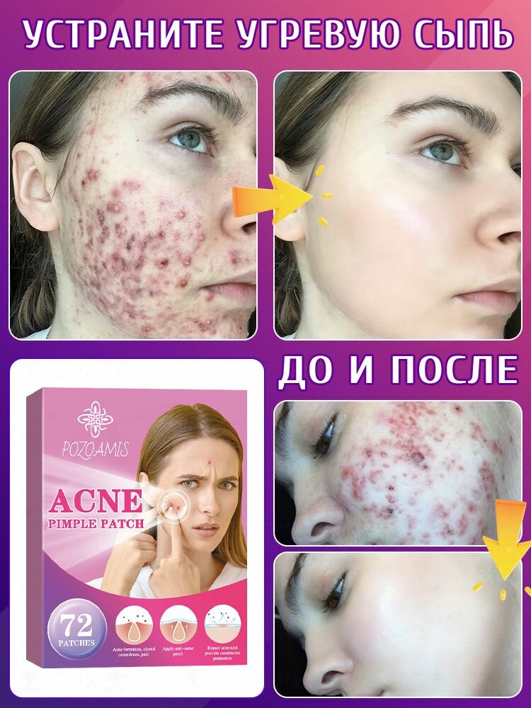 Пластыри для лица от прыщей и чёрных точек, крем от прыщей для подростков с проблемной кожей, эффективно снимает воспаление и угри, 72 пластыря
