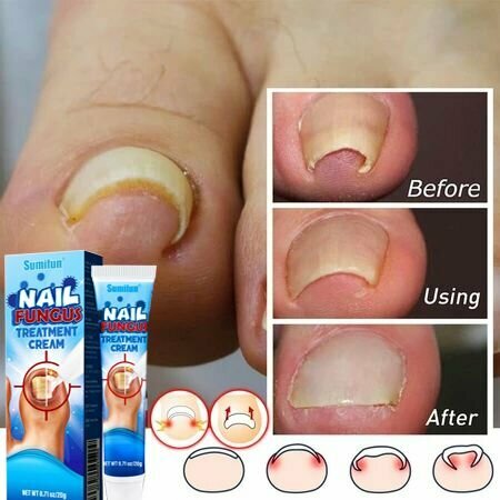 Ногтей восстанавливающий Средство от грибка ногтей на ногах противогрибковое для роста и укрепление 20 мл