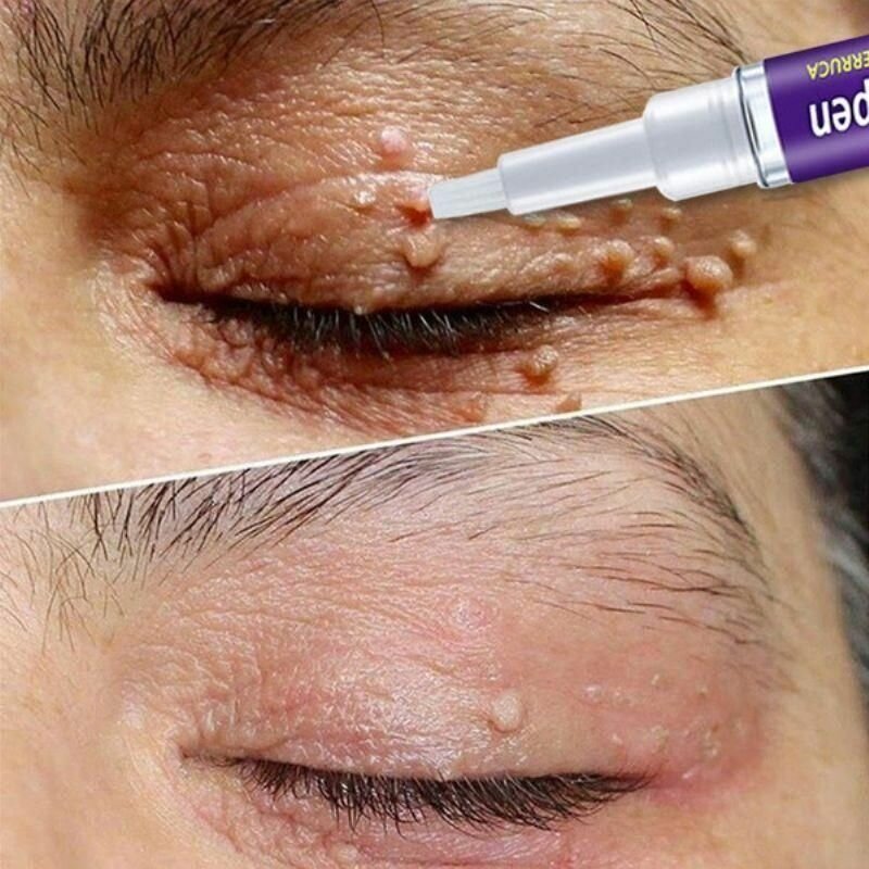 Крем для удаления меток кожи лечение бородавок шея подмышка плоские гениталии-JH