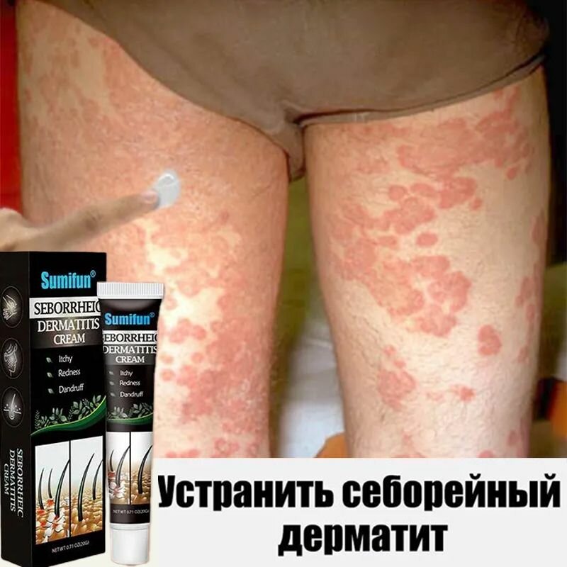 Мазь от атопического дерматита, 20 грамм, используется для лечения псориаза, себорейного дерматита и зуда кожи головы, эффективно устраняет перхоть, снимает воспаление и зуд