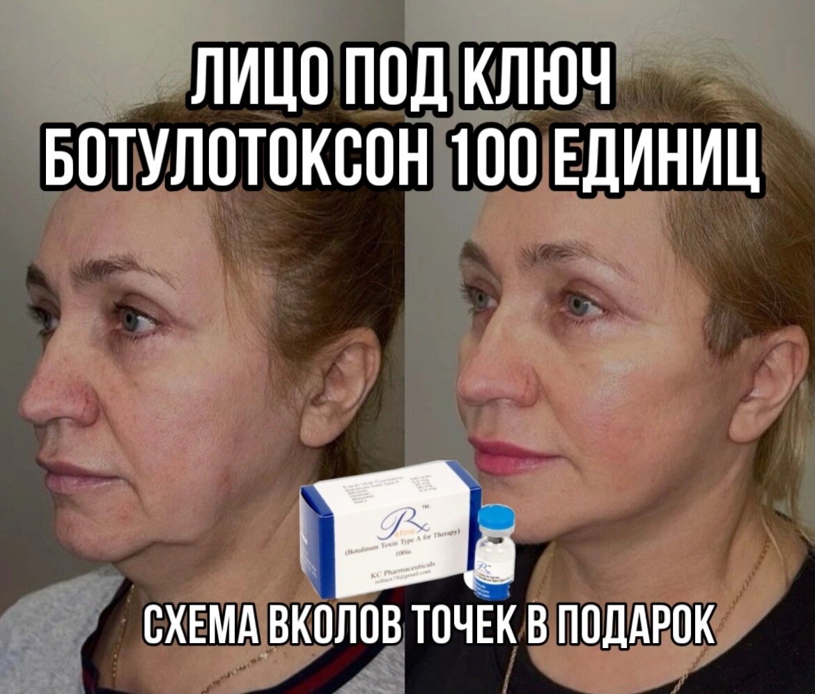 Омоложение лица ботоксом на 10 лет с инструкцией по применению