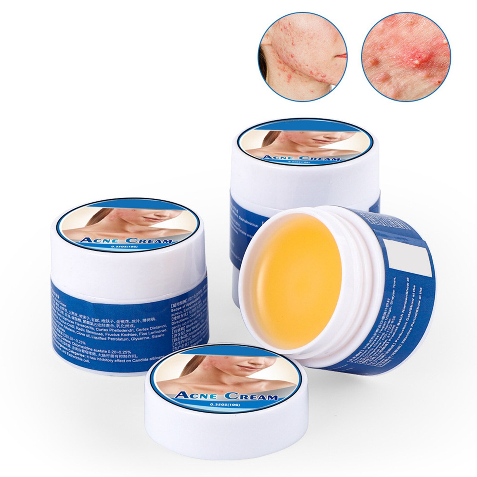 Крем для удаления прыщей 10 г. Натуральный растительный крем от прыщей, сужающий поры, увлажняющая мазь от прыщей