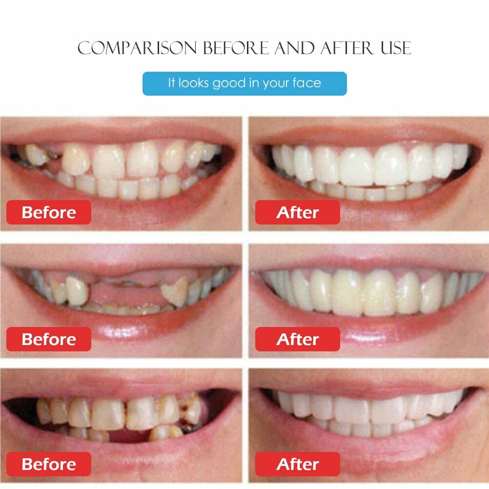Силиконовые виниры на зубы для идеальной улыбки, съемные многоразовые, тонкие и гибкие, маскируют сколы и пятна, подходят для свиданий и важных встреч