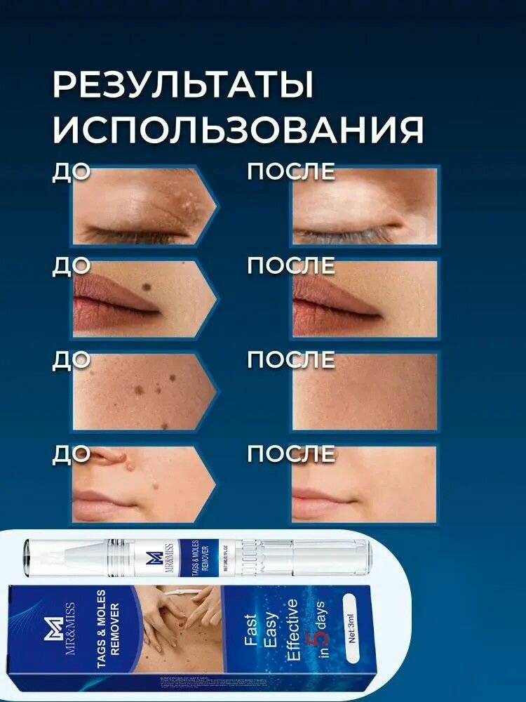 Карандаши для удаления бородавокдля лечения бородавок, средство от папиллом, от бородавок, от мозолей, безболезненный и не вызывающий раздражения / 3 мл