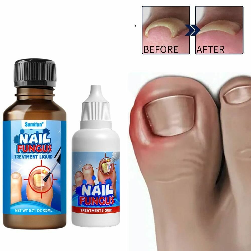 Средство от грибка ногтей на ногах; Противогрибковая мазь на основе натуральных компонентов