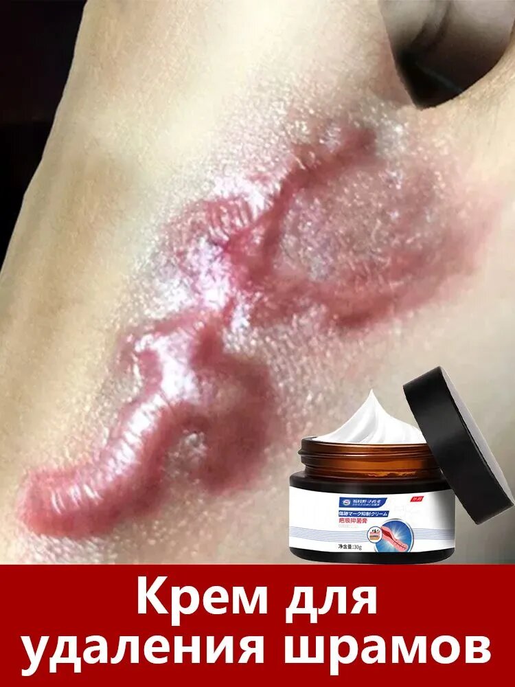 Крем для удаления рубцов 30 г вогнутые и выпуклые шрамы восстановление следов от прыщей ожогов шрамов от гиперплазии