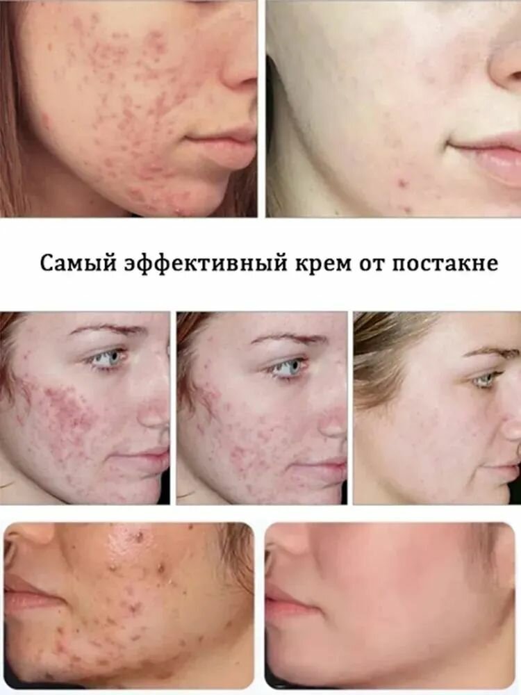 Крем против угревой сыпи 30 мл, снимает воспаление, устраняет угревую сыпь, эффективно удаляет угри и успокаивает кожу