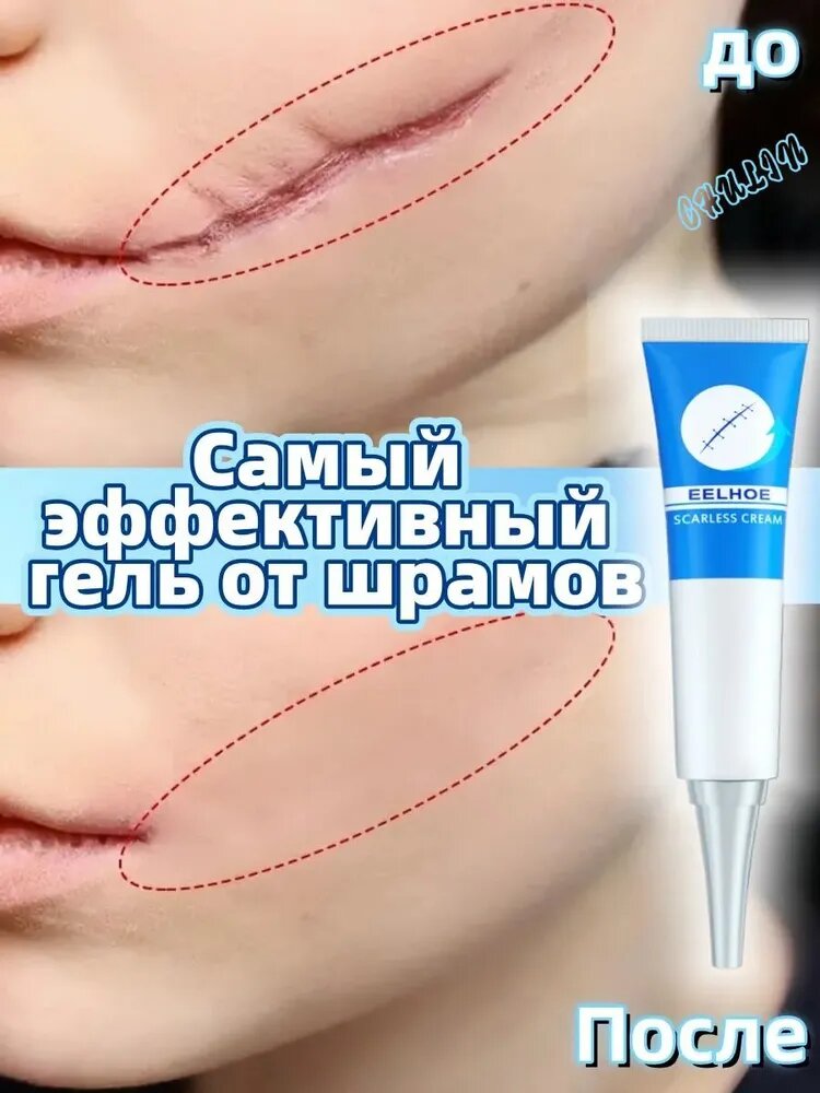 EELHOE Scarless Cream Гель от шрамов и рубцов 20 г для лица
